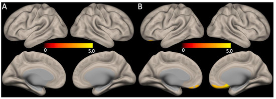 Depression Is Associated with the Aberration of Resting State Default ...