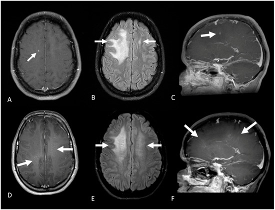 Supratentorial Lymphocytic Inflammation with Parenchymal Perivascular ...