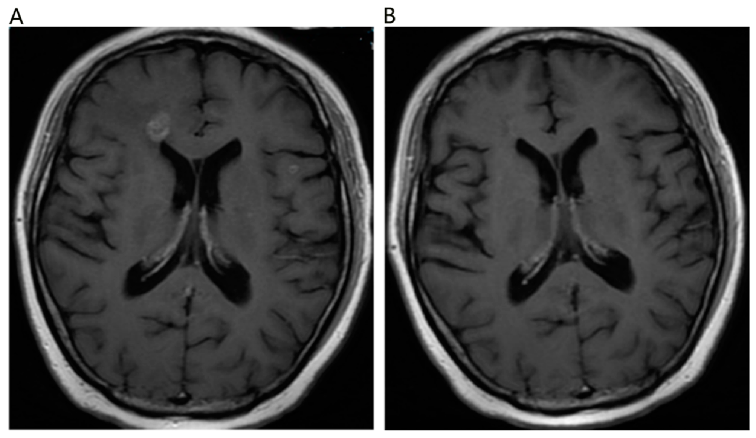 Brain Sciences | Free Full-Text | Effect of Different Timing of Local ...