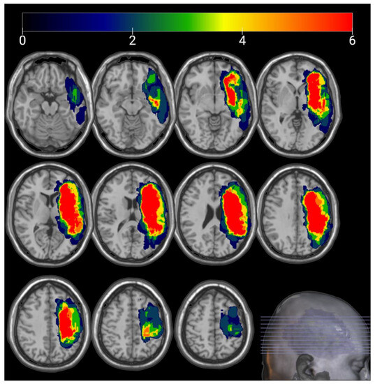 Effects of Damage to the Integrity of the Left Dual-Stream ...