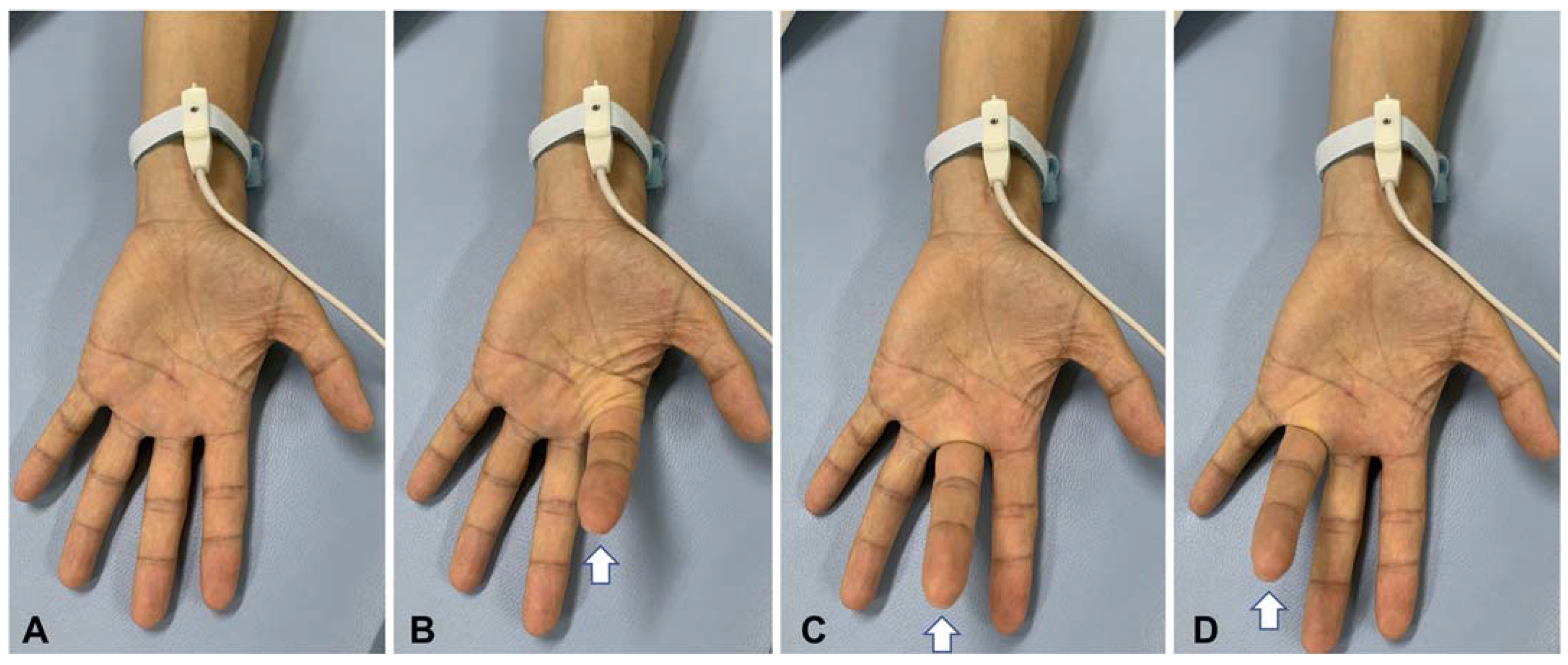 Sensory Gating during Voluntary Finger Movement in Amyotrophic Lateral ...