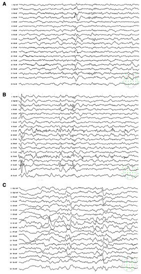 Diagnosis and Treatment of X-Linked Creatine Transporter Deficiency ...