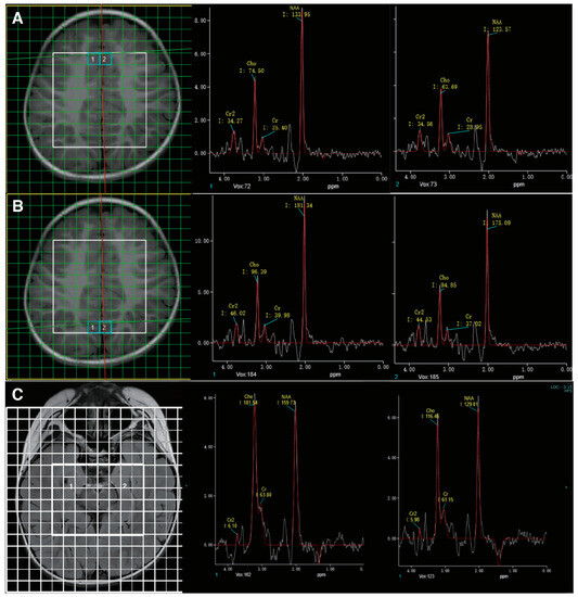 Diagnosis and Treatment of X-Linked Creatine Transporter Deficiency ...