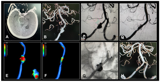 Overlapping Stent Treatment for Ruptured Dissecting Aneurysms in ...