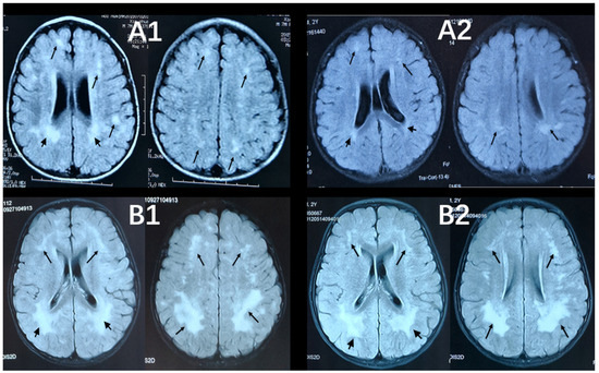 Developmental Auditory and Speech–Language Performance in Pediatric ...