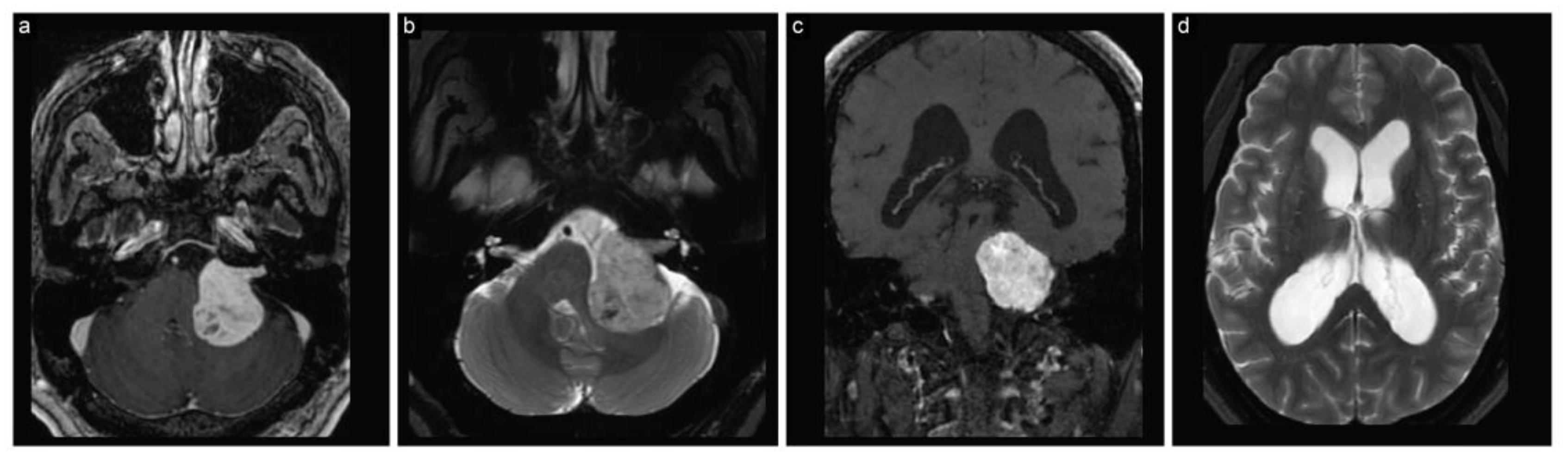 Two-Stage Surgical Management for Acutely Presented Large Vestibular ...