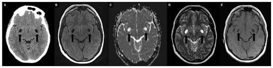 Overview of the Current Knowledge and Conventional MRI Characteristics ...