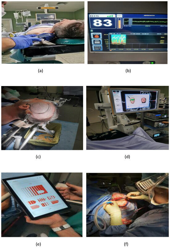 Awake Craniotomy in Conscious Sedation: The Role of A2 Agonists