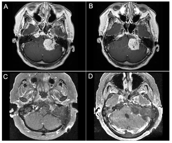 Jugular Foramen Tumors: Surgical Strategies and Representative Cases