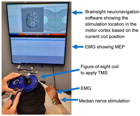 Cortical Sensorimotor Integration as a Neural Origin of Impaired Grip ...