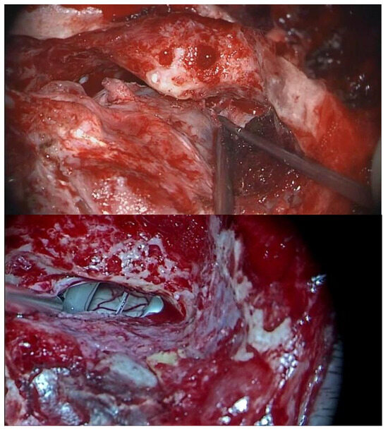 Selective Vestibular Neurectomy through the Presigmoid ...