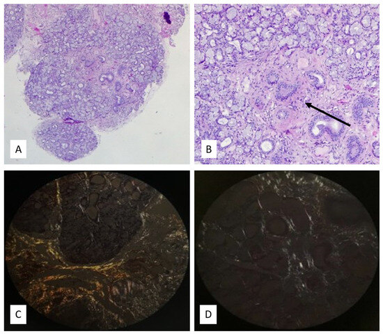 Successful Treatment with Patisiran in Amyloid Polyneuropathy Harboring ...