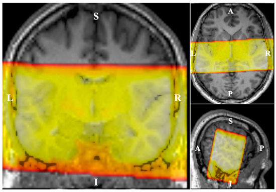 Sound-Evoked Neural Activity in Normal-Hearing Tinnitus: Effects of ...