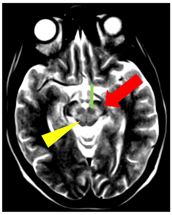 Brain Magnetic Resonance Imaging in Wilson’s Disease—Significance and ...