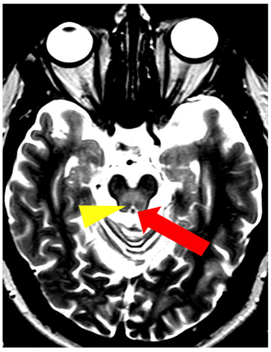 Brain Magnetic Resonance Imaging in Wilson’s Disease—Significance and ...