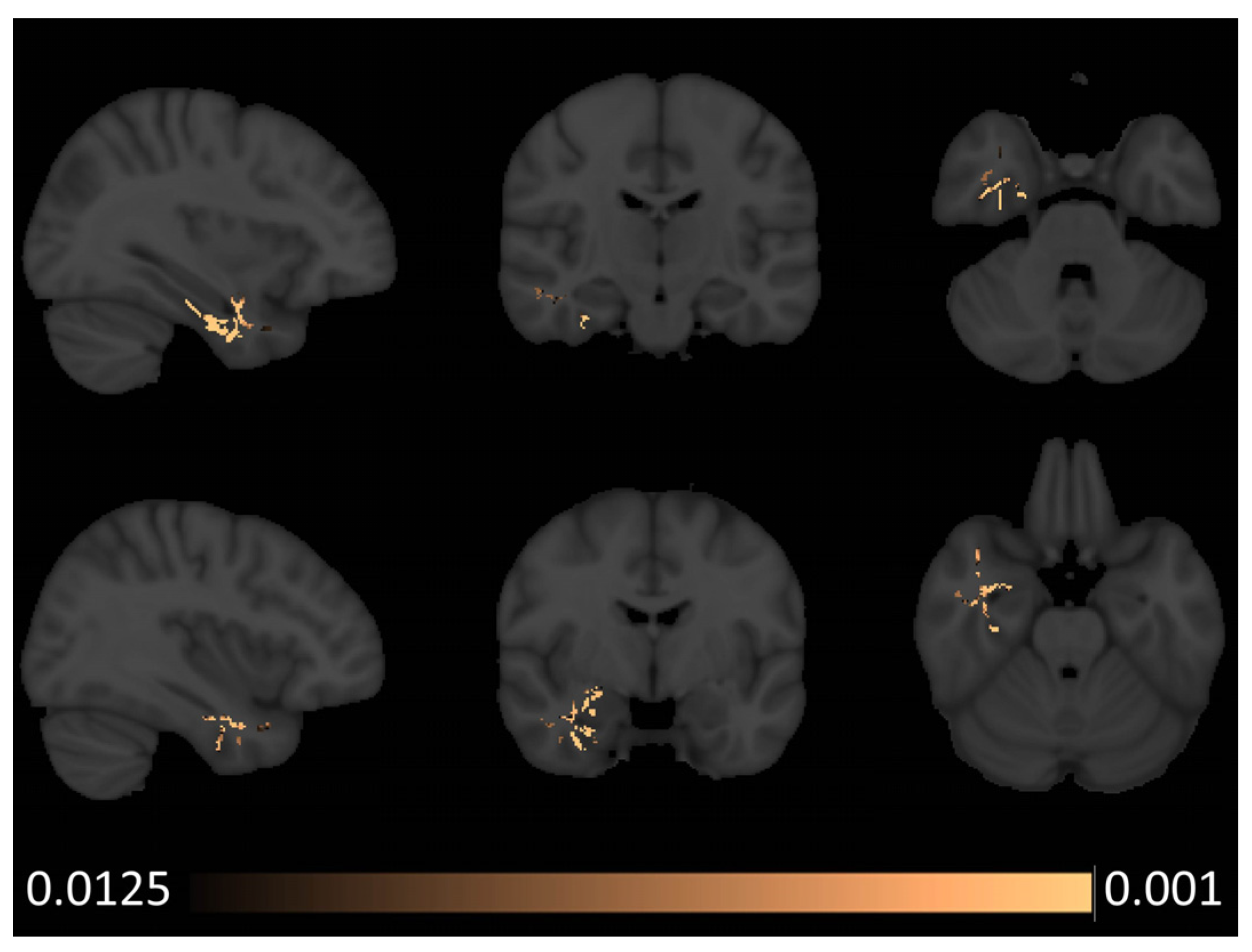Brain Sciences | Free Full-Text | Clinical, Cortical, Subcortical, and ...