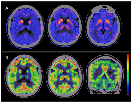 Brain Evaluation by Dual PET/CT with [18F] FDOPA and [18F] FDG in Differential Diagnosis of ...