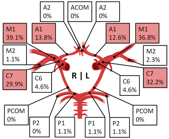 Coincidence of Concentric Vessel-Wall Contrast Enhancement in Moyamoya ...