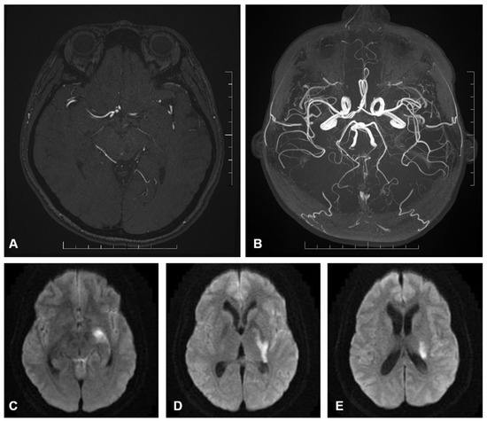 Management of Anterior Choroidal Artery Aneurysms: A Retrospective ...