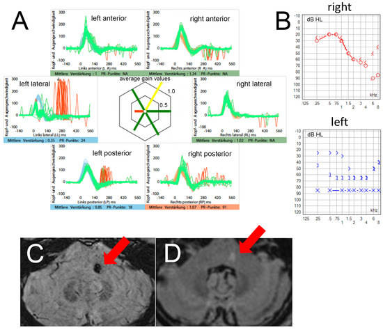 Diagnostic Errors in the Acutely Dizzy Patient—Lessons Learned