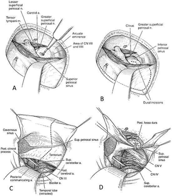 Anterior Petrosectomy vs. Retrosigmoid Approach—Surgical Anatomy and ...