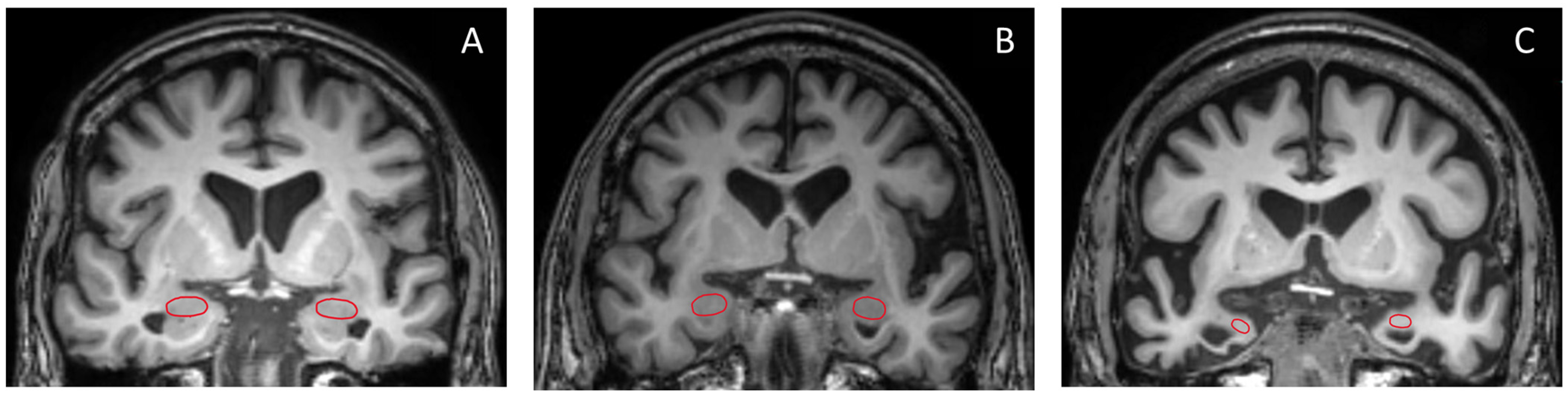 A Comparison of the Brain Parameters of Thais with Normal Cognition, Mild Cognitive Impairment ...