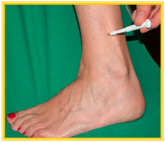 Small-Fiber Neuropathy: An Etiology-Oriented Review