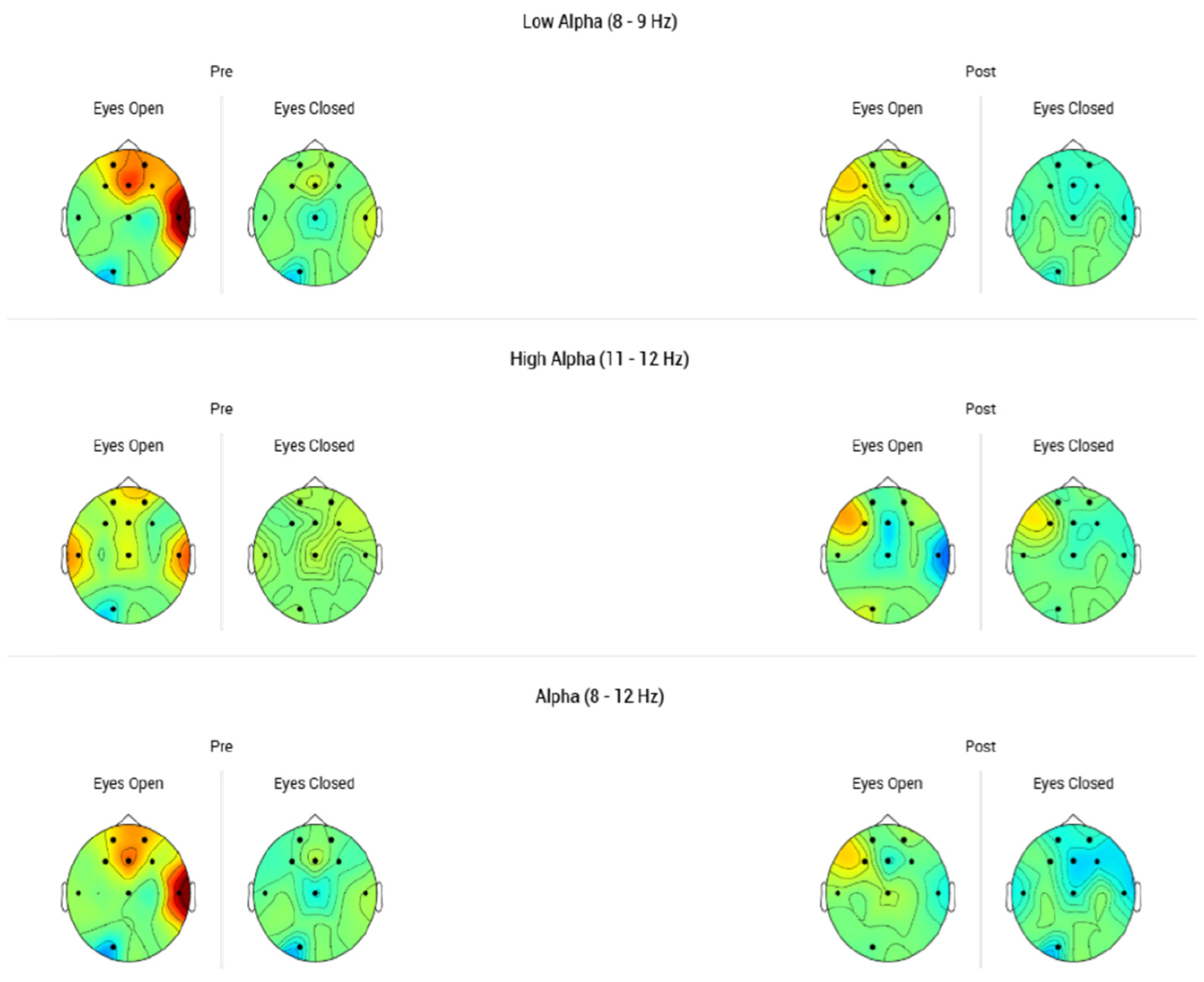 Frontal Transcranial Direct Current Stimulation in Moderate to Severe ...