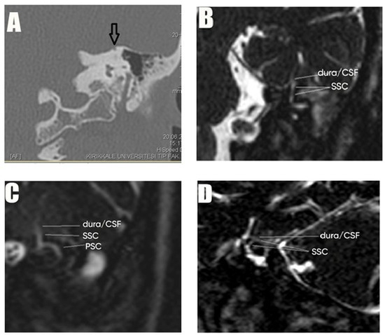 Is CT Still the Gold Standard in Semicircular Canal Dehiscence ...