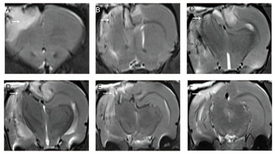 Contralateral Structure and Molecular Response to Severe Unilateral ...