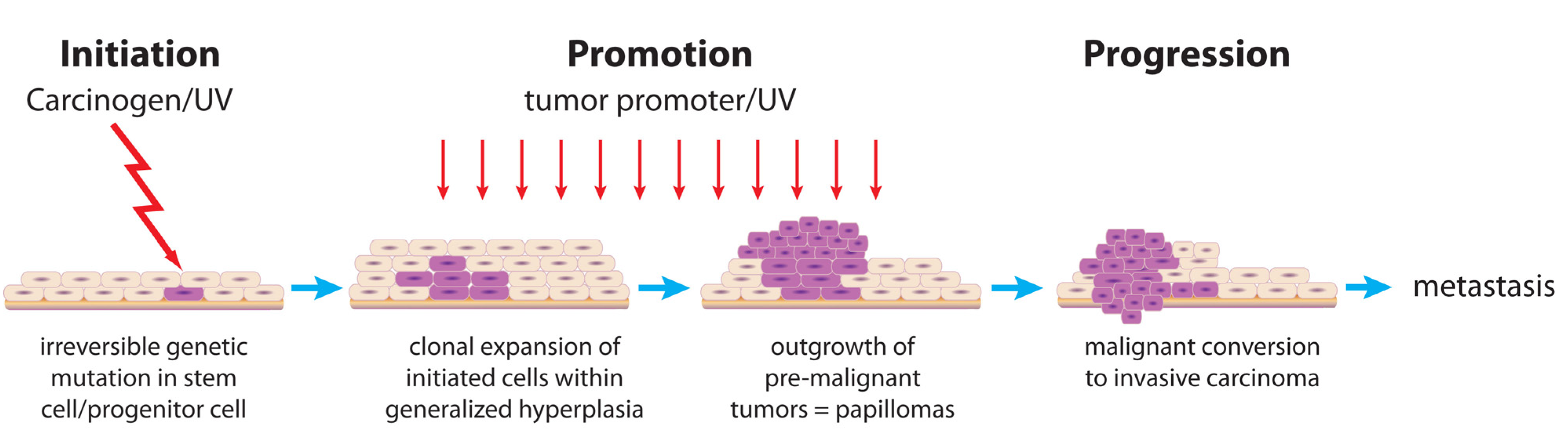 Carcinogenesis Initiation Promotion Progression