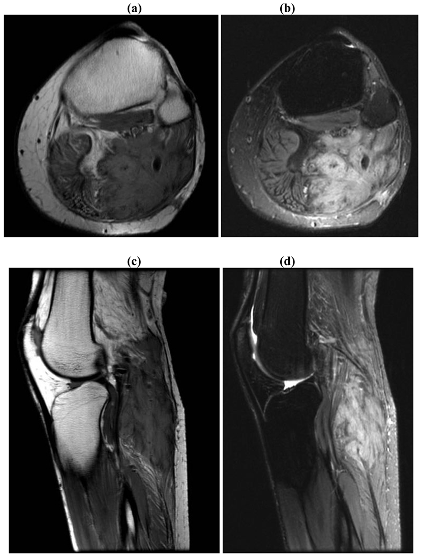 Current Perspectives on Desmoid Tumors: The Mayo Clinic Approach