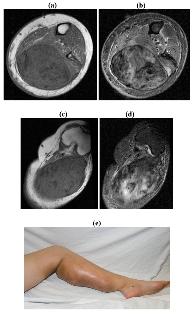 Current Perspectives on Desmoid Tumors: The Mayo Clinic Approach
