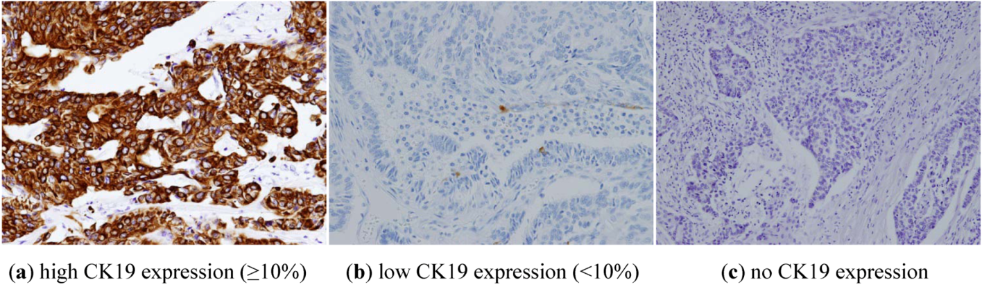 Clinical Significance of CK19 Negative Breast Cancer