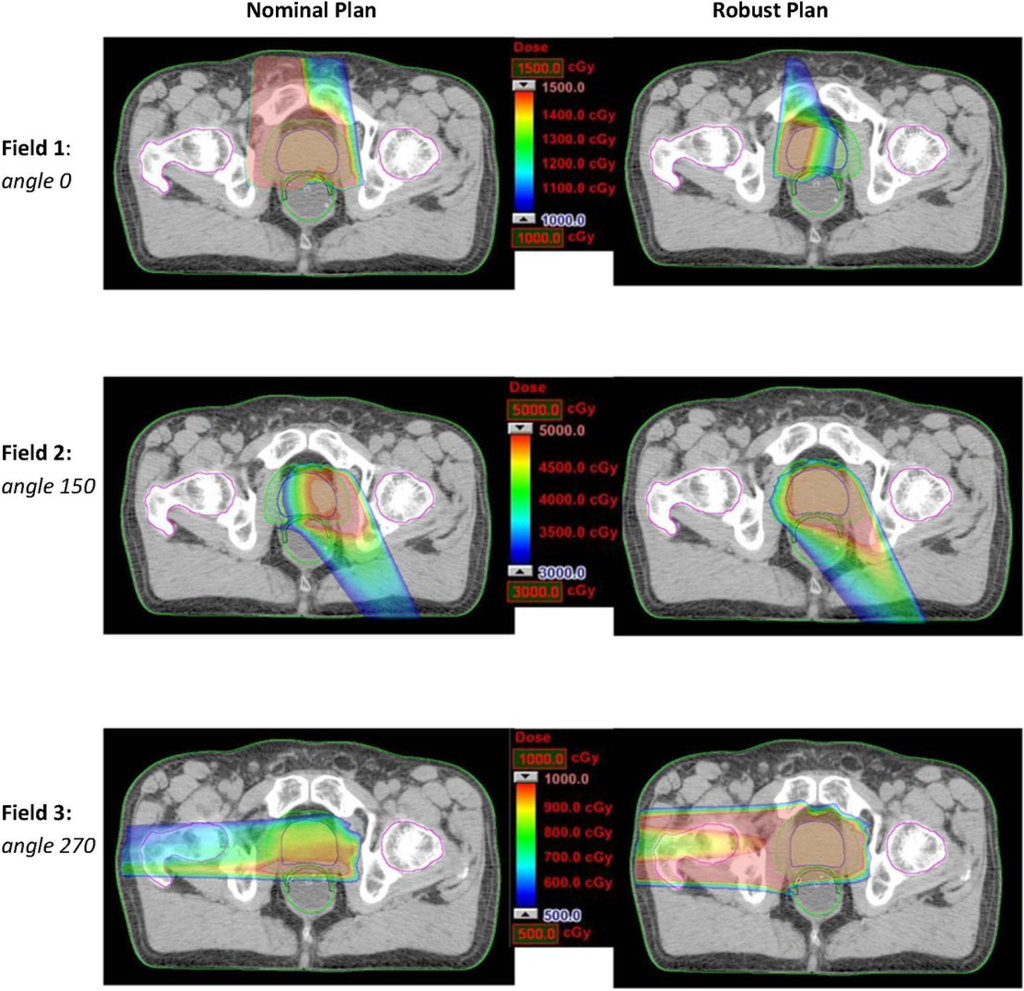 Improved Beam Angle Arrangement in Intensity Modulated Proton Therapy ...