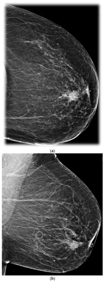 Retroareolar Carcinomas in Breast Ultrasound: Pearls and Pitfalls