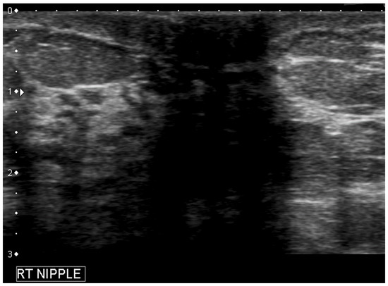 Retroareolar Carcinomas in Breast Ultrasound: Pearls and Pitfalls