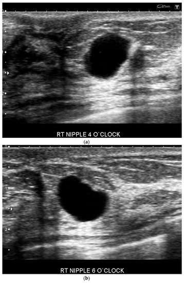 Retroareolar Carcinomas in Breast Ultrasound: Pearls and Pitfalls