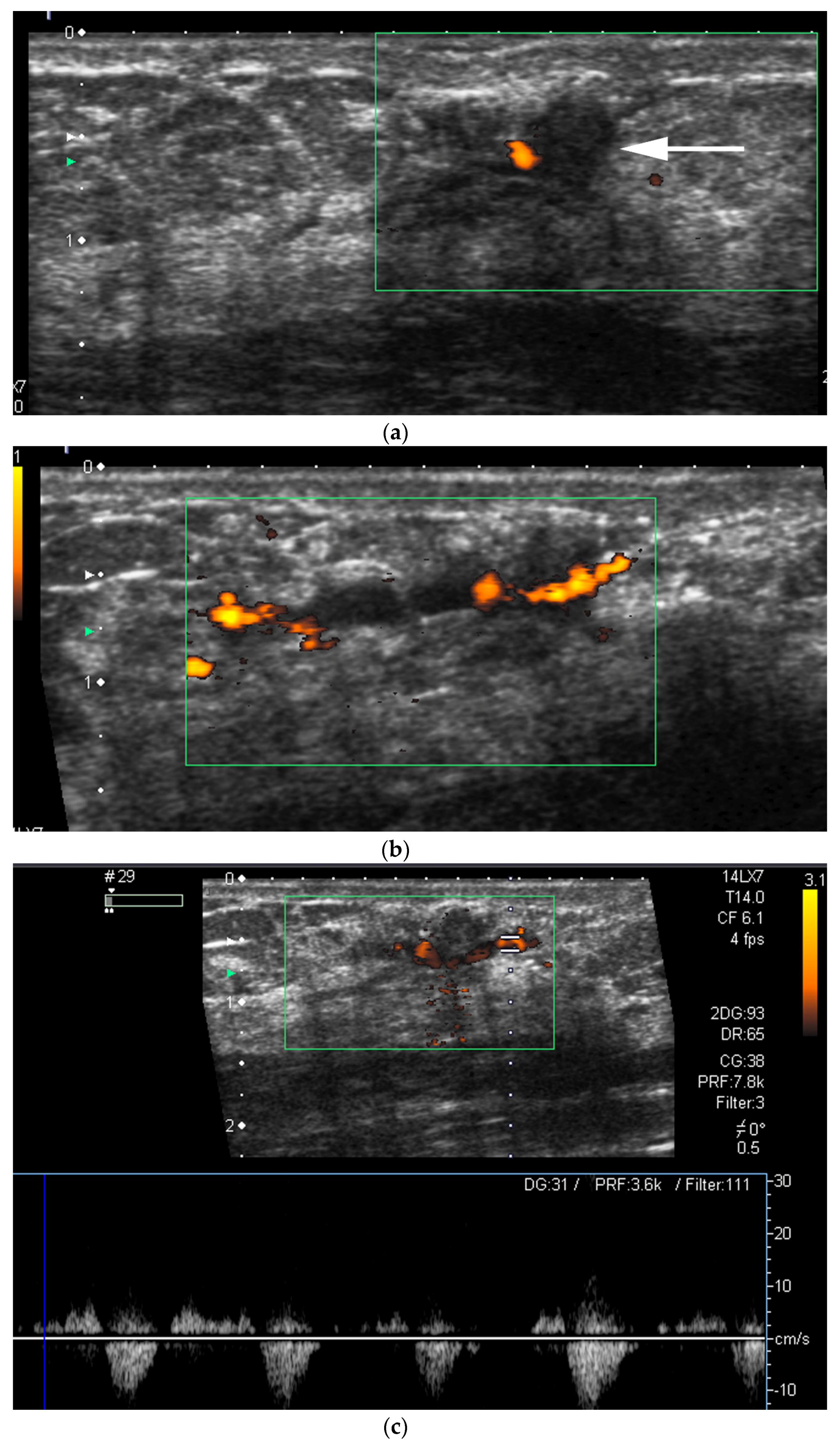 Retroareolar Carcinomas in Breast Ultrasound: Pearls and Pitfalls
