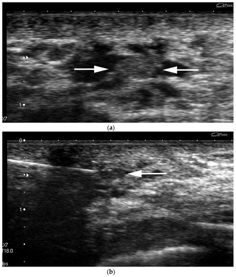 Retroareolar Carcinomas in Breast Ultrasound: Pearls and Pitfalls