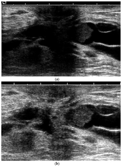 Retroareolar Carcinomas in Breast Ultrasound: Pearls and Pitfalls