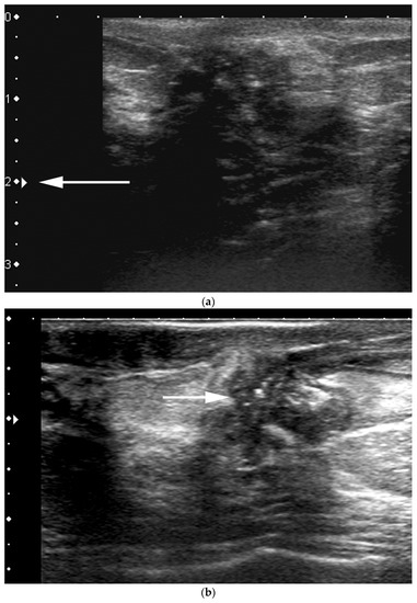 Retroareolar Carcinomas in Breast Ultrasound: Pearls and Pitfalls