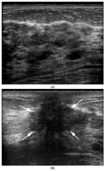 Retroareolar Carcinomas in Breast Ultrasound: Pearls and Pitfalls