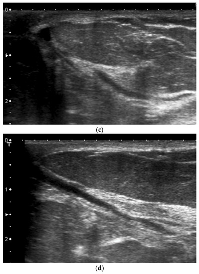 Retroareolar Carcinomas in Breast Ultrasound: Pearls and Pitfalls