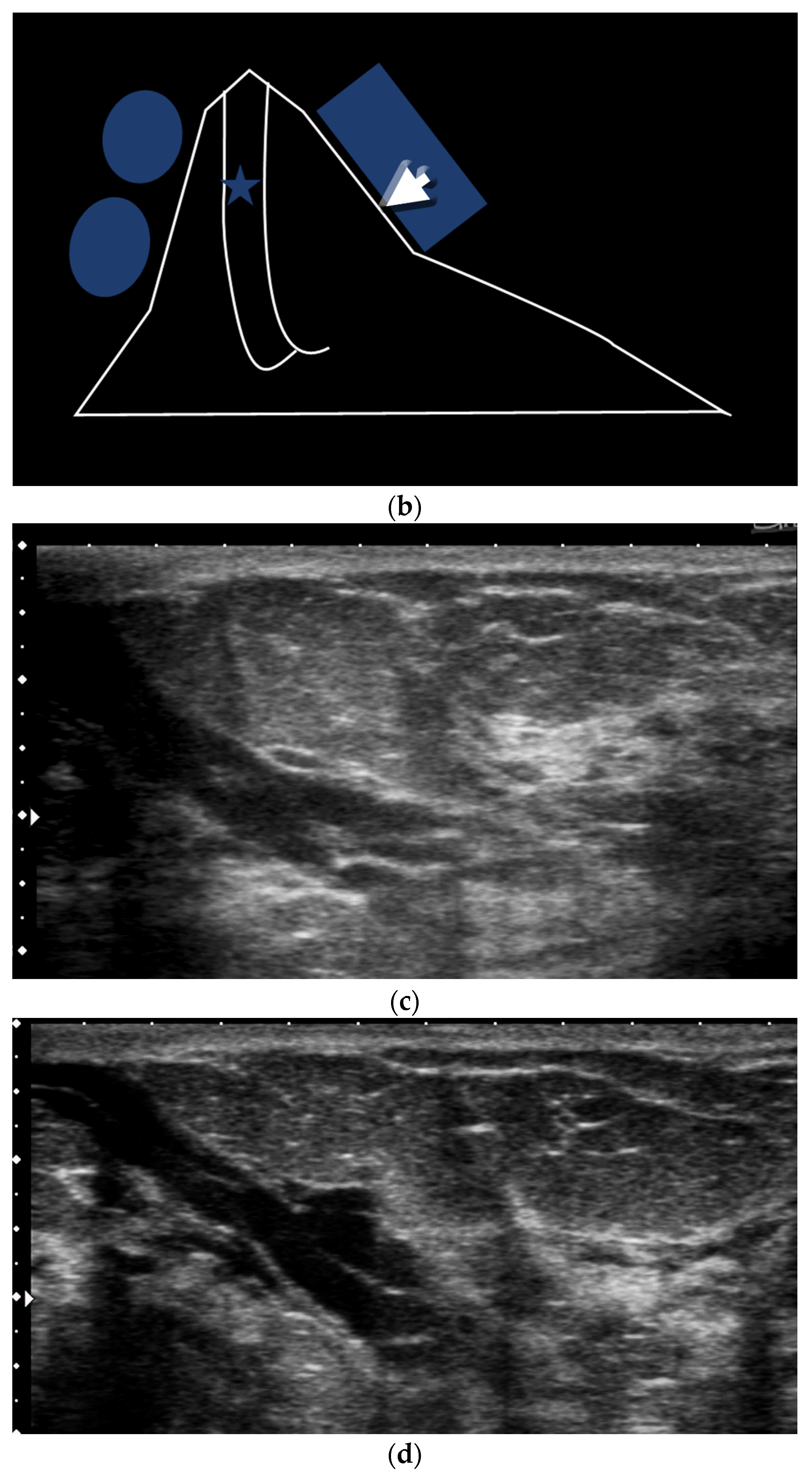 Retroareolar Carcinomas in Breast Ultrasound: Pearls and Pitfalls