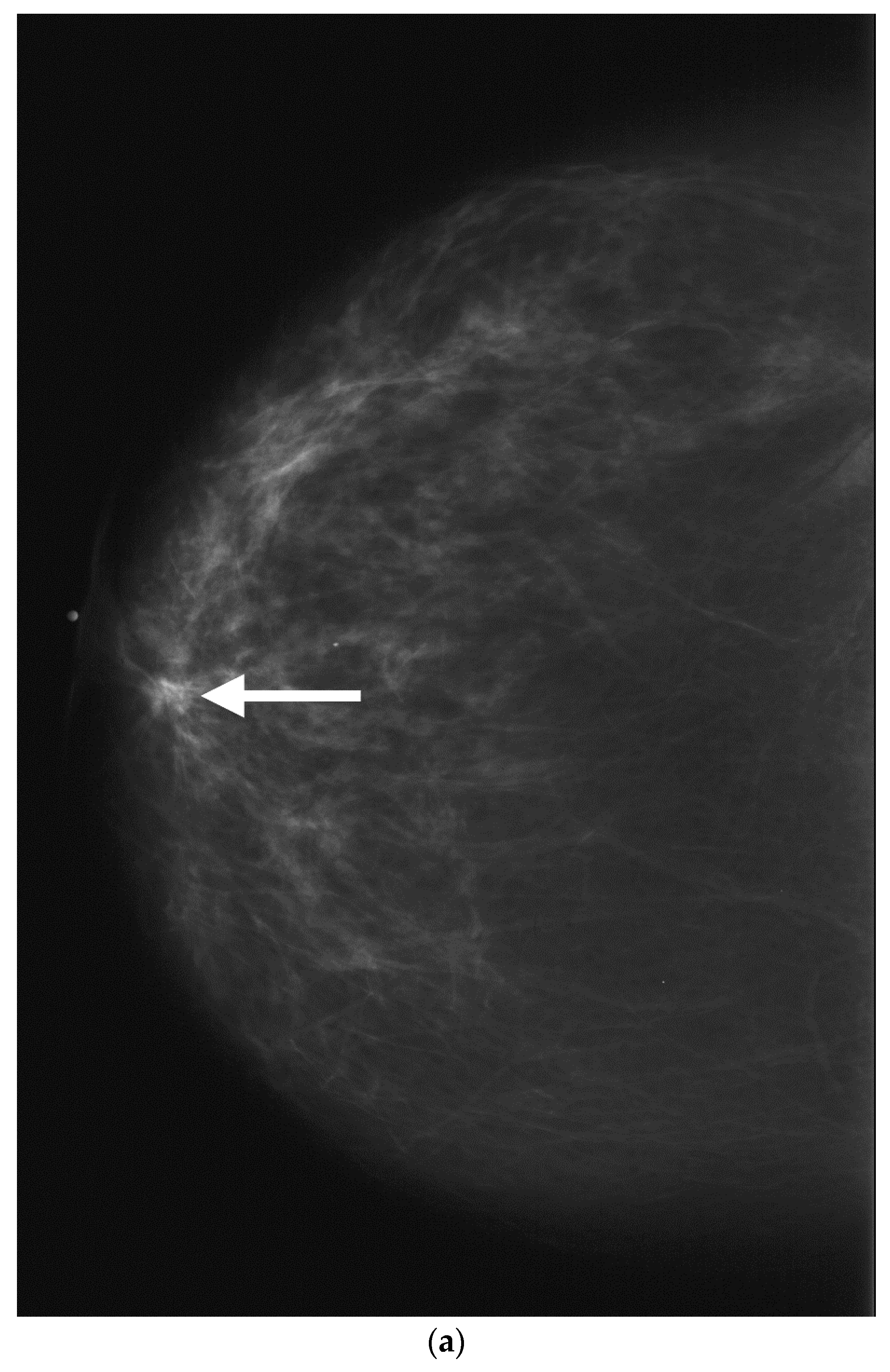 Retroareolar Carcinomas in Breast Ultrasound: Pearls and Pitfalls