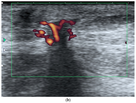Retroareolar Carcinomas in Breast Ultrasound: Pearls and Pitfalls
