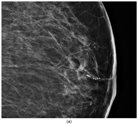 Retroareolar Carcinomas in Breast Ultrasound: Pearls and Pitfalls
