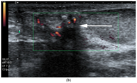 Retroareolar Carcinomas in Breast Ultrasound: Pearls and Pitfalls