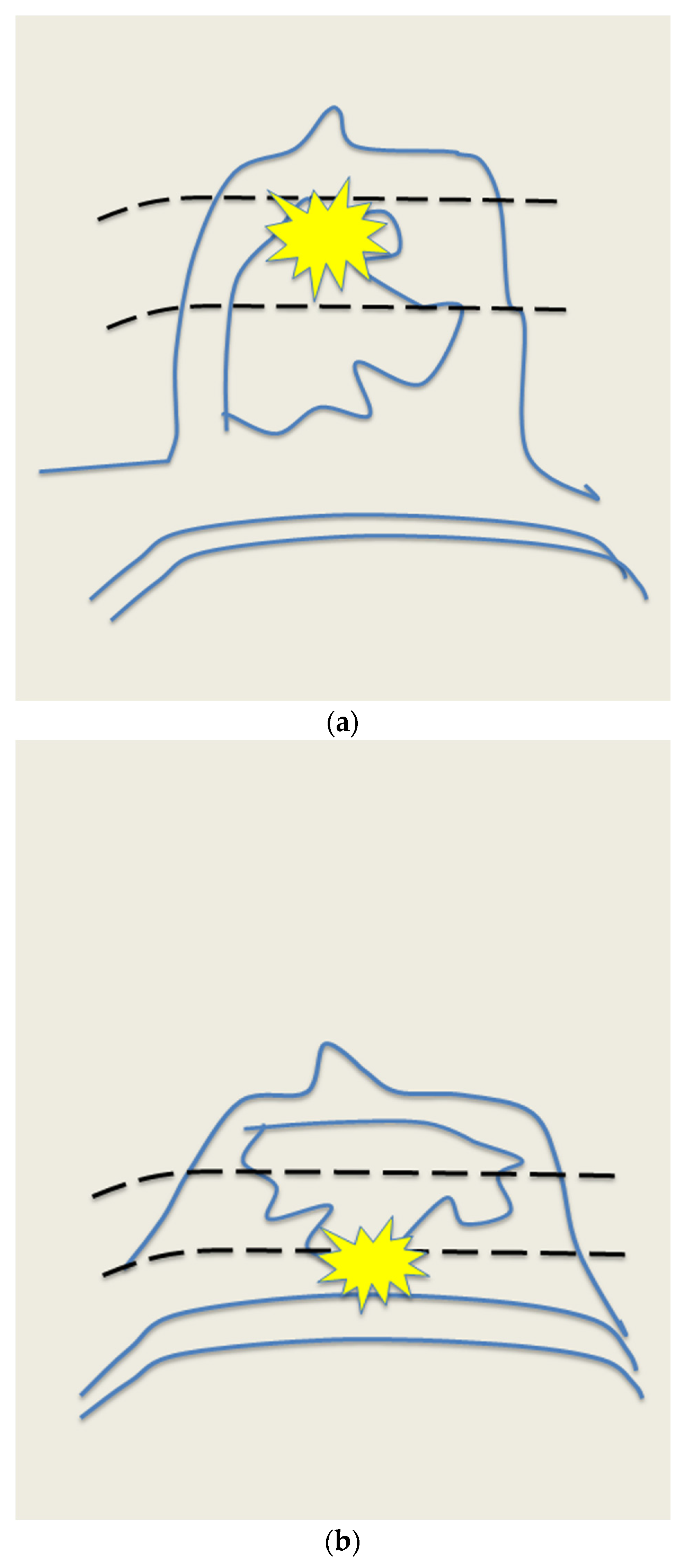 Retroareolar Carcinomas in Breast Ultrasound: Pearls and Pitfalls